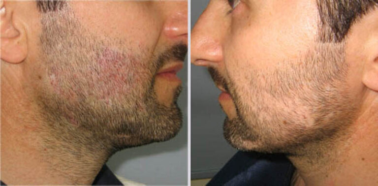 Transplante de barba um símbolo de respeito - Dr. Weber Ignacio